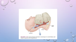 Pulmonary capillary wedge pressure or PCWP.pptx