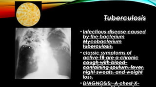 Pulmonary causes of chest pain | PPT