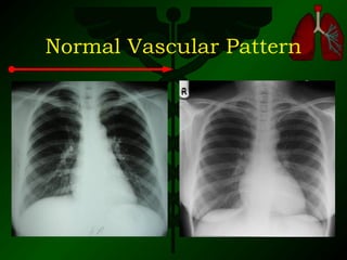 Pulmonary Circulation in Radiography.ppt