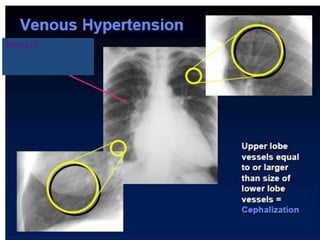 Cephalization Of Pulmonary Vessels