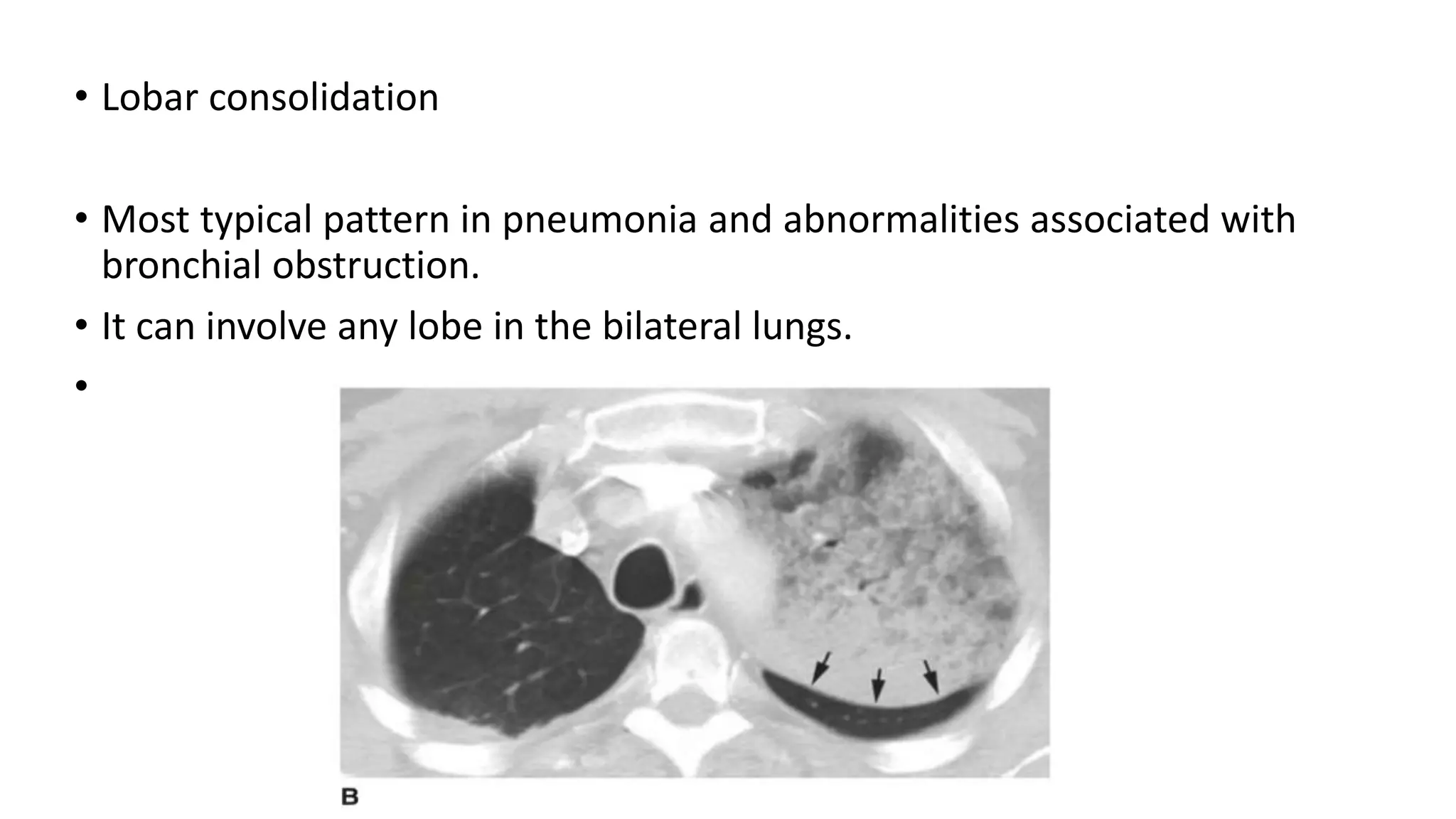PULMONARY COLLAPSE AND CONSOLIDATION.pptx
