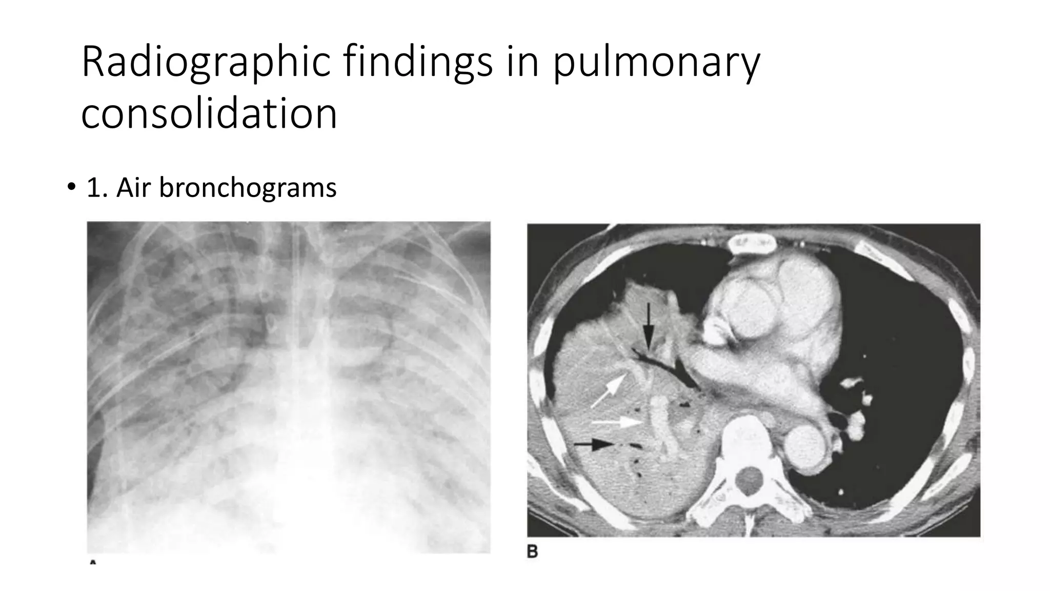 PULMONARY COLLAPSE AND CONSOLIDATION.pptx