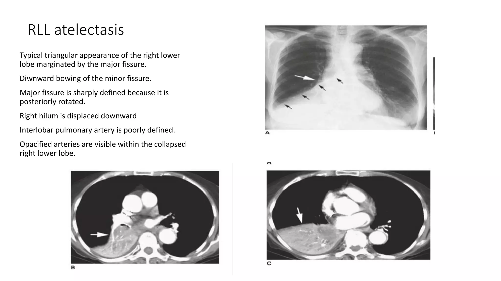 PULMONARY COLLAPSE AND CONSOLIDATION.pptx