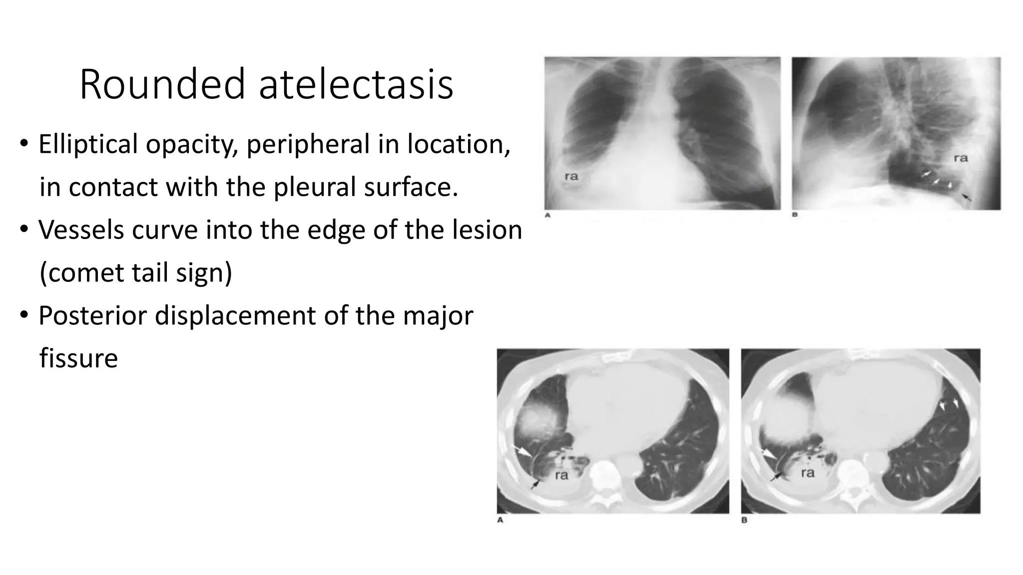 PULMONARY COLLAPSE AND CONSOLIDATION.pptx