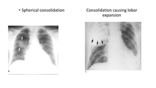 PULMONARY COLLAPSE AND CONSOLIDATION.pptx | Lung and Respiratory Health ...
