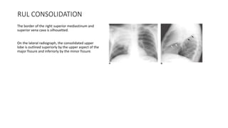 PULMONARY COLLAPSE AND CONSOLIDATION.pptx