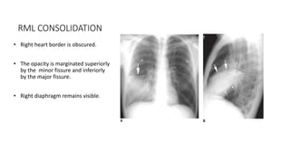 PULMONARY COLLAPSE AND CONSOLIDATION.pptx | Lung and Respiratory Health ...