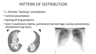 PULMONARY COLLAPSE AND CONSOLIDATION.pptx