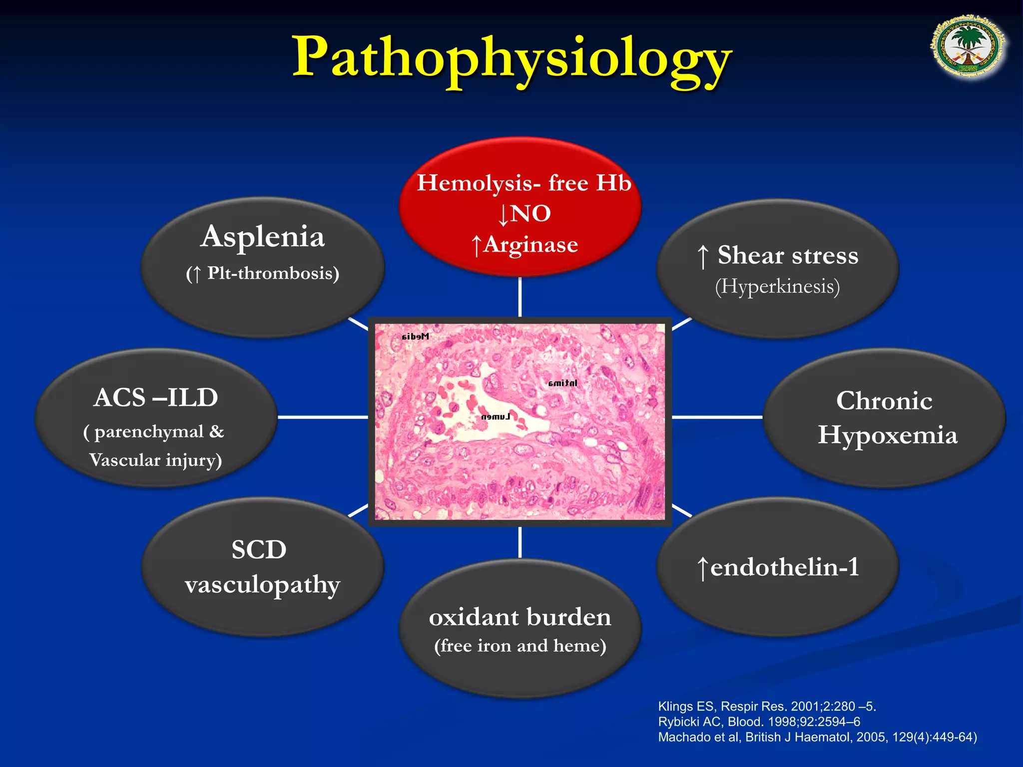 Pulmonary Complications of Sickle Cell Disease. pptx | PDF