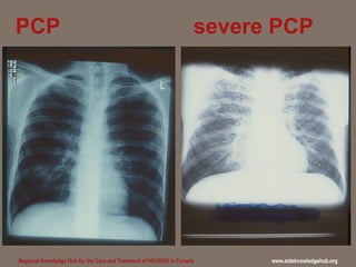 Pulmonary complications eng_d4-5 | PPT