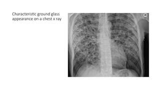 pulmonary complications of advanced HIV disease | PPTX