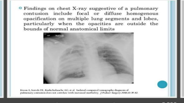 Pulmonary contusion | PPTX