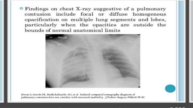 Pulmonary contusion