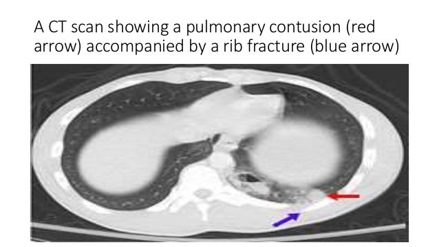 Pulmonary contusion