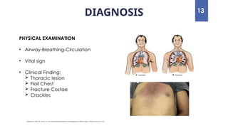 Pulmonary Contusion : definition untul treatment | PPTX
