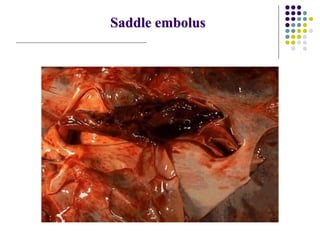 Pulmonary diseases of vascular origin(pulmonary embolism) | PPT