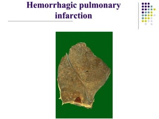Pulmonary Infarction Gross