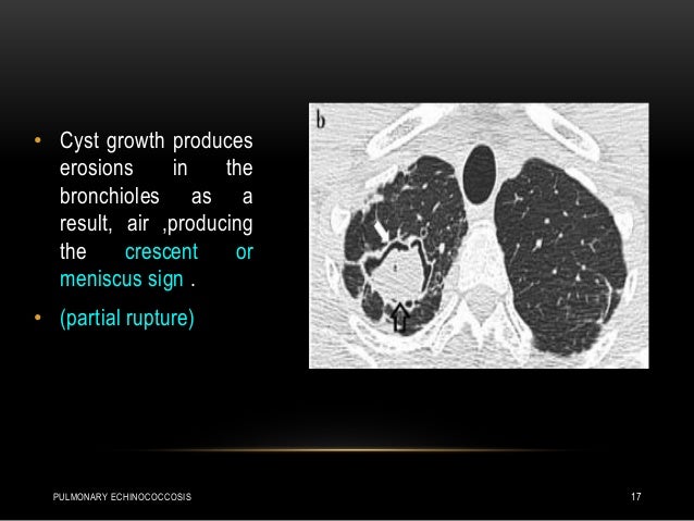 Pulmonary echinococcosis