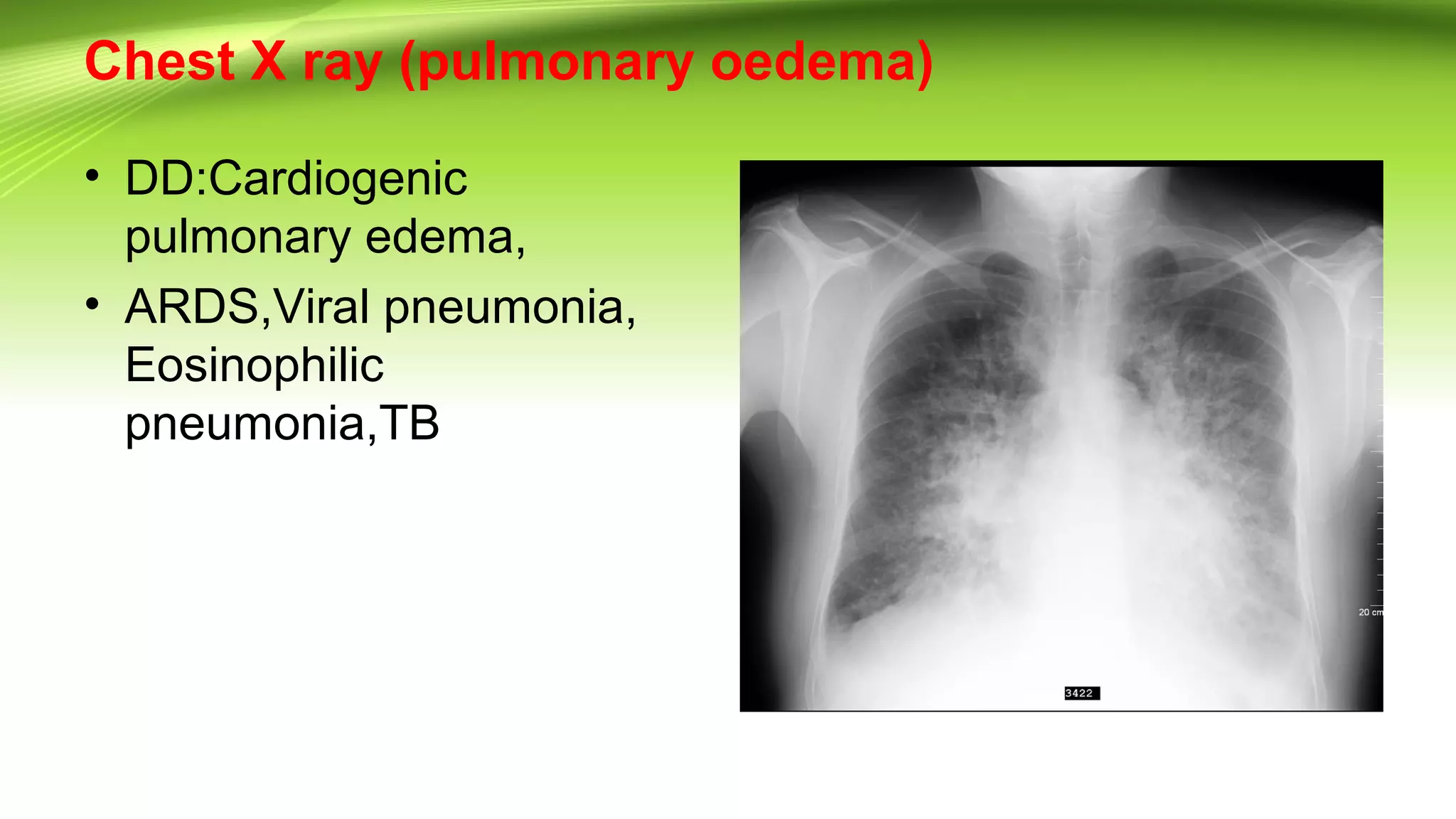 Pulmonary edema | PPT