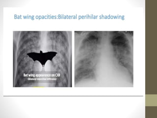 Pulmonary edema.pptx