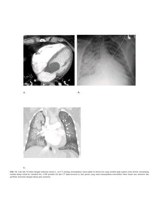Pulmonary Edema - Imaging Manifestations_compressed id (1).docx