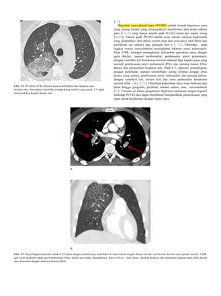 Pulmonary Edema - Imaging Manifestations_compressed id (1).docx