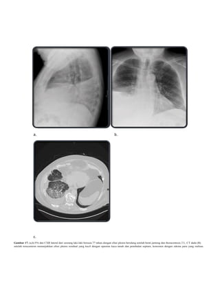 Pulmonary Edema - Imaging Manifestations_compressed id (1).docx