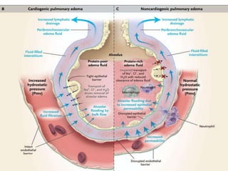 Pulmonary Edema Pathophysiology
