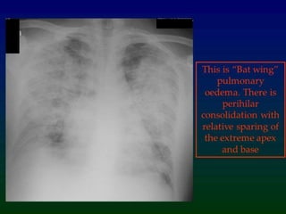 Pulmonary edema & Management | PPTX
