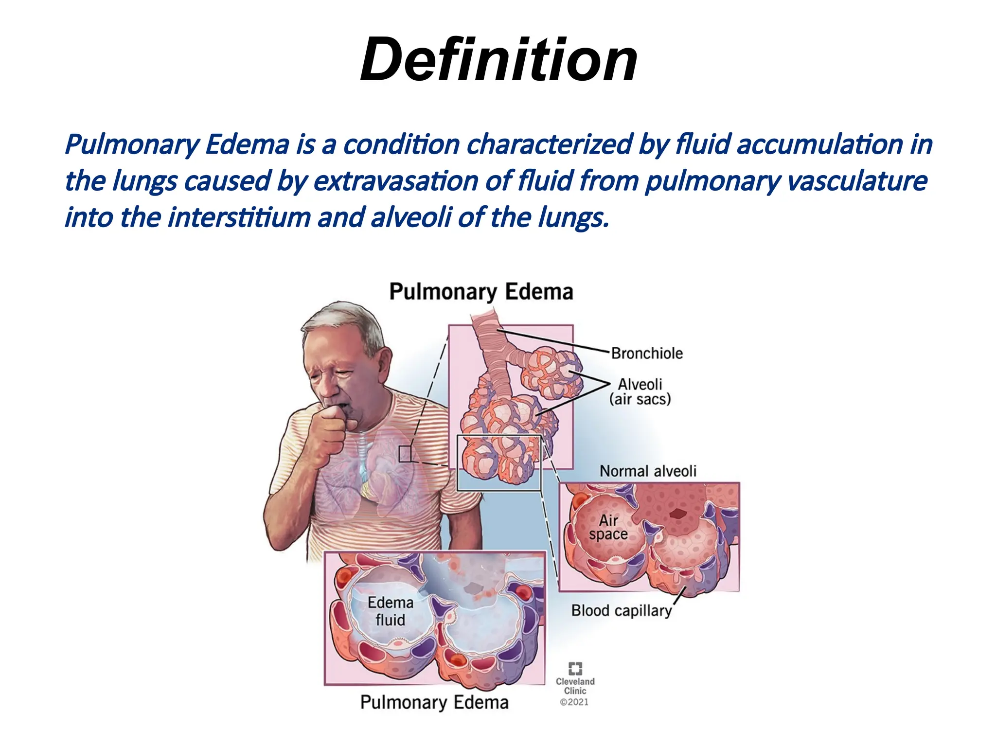 Pulmonary edema classification,management and its anesthetic ...