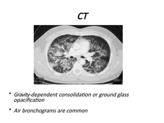 Pulmonary edema classification,management and its anesthetic ...