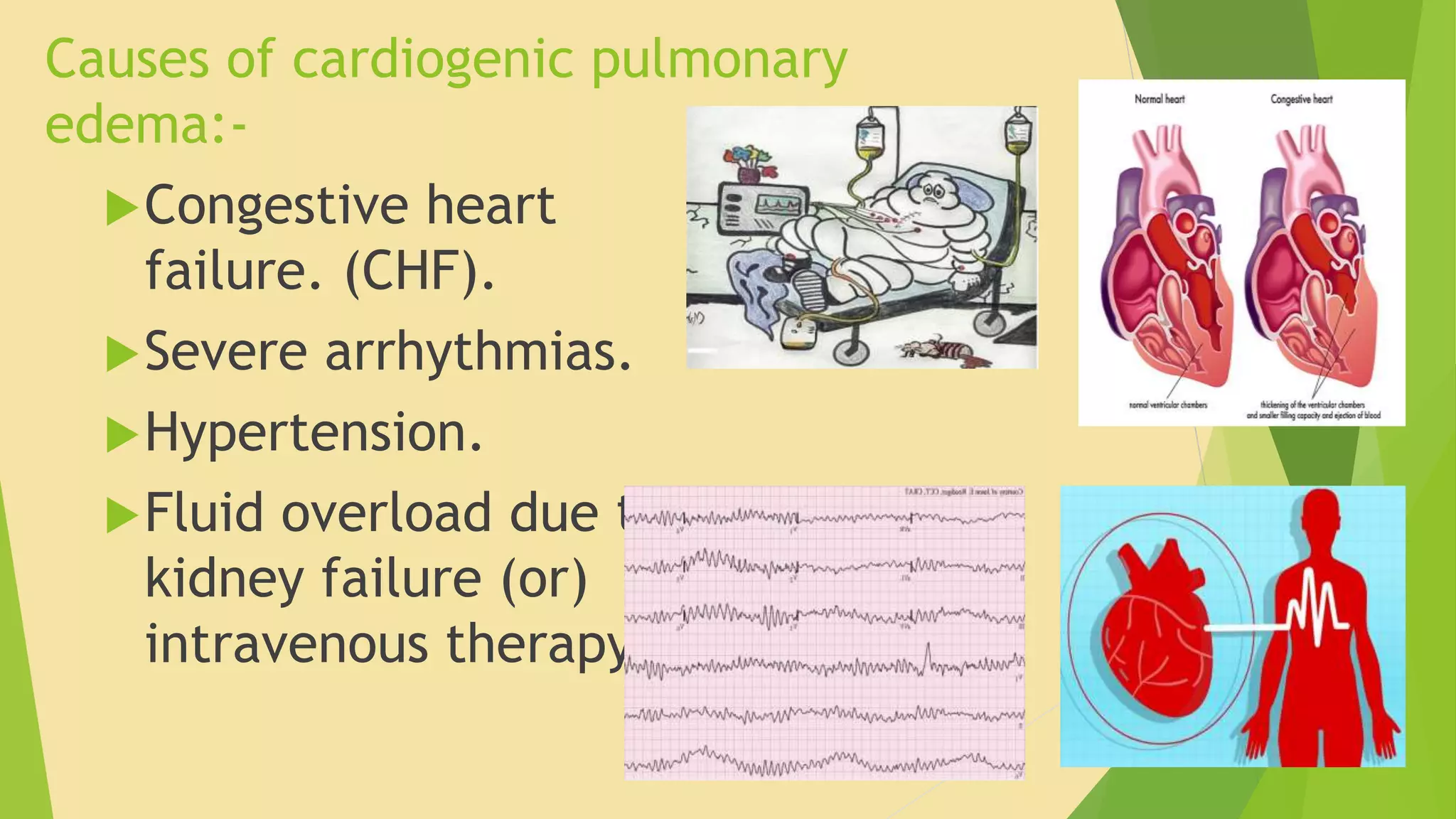 Pulmonary edema roge ppt (1) | PPTX