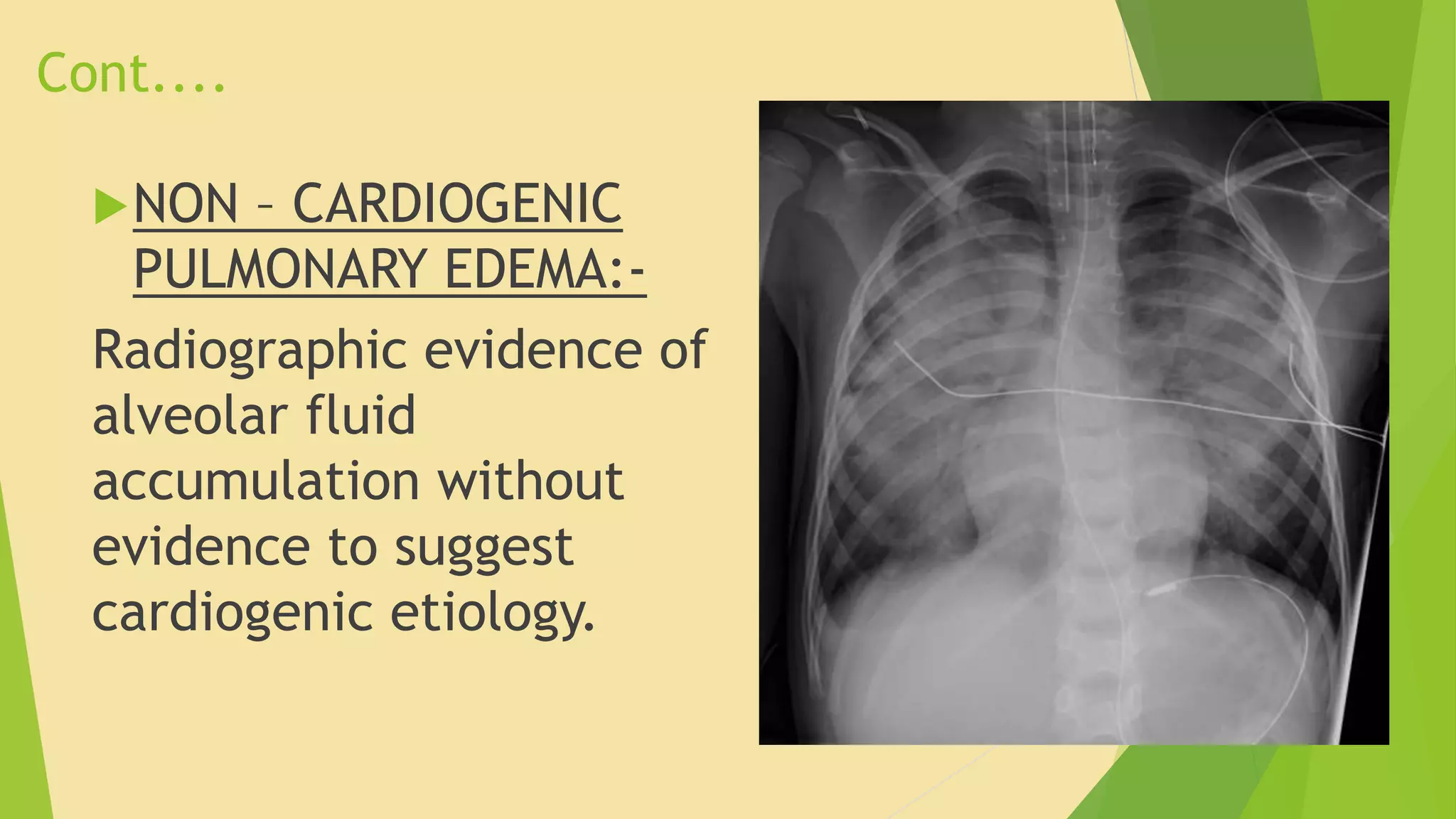 Pulmonary edema roge ppt (1) | PPTX