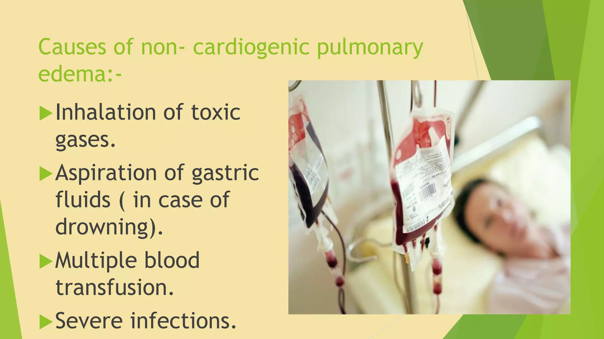 Pulmonary edema roge ppt (1) | PPTX