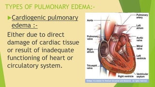 Pulmonary edema roge ppt (1) | PPTX