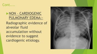 Pulmonary edema roge ppt (1) | PPTX