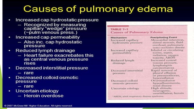 Pulmonary edema roge ppt (1) | PPTX