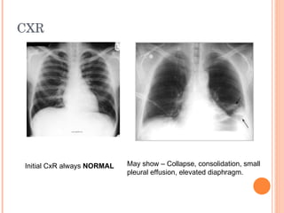 Pulmonary Embolism | PPT