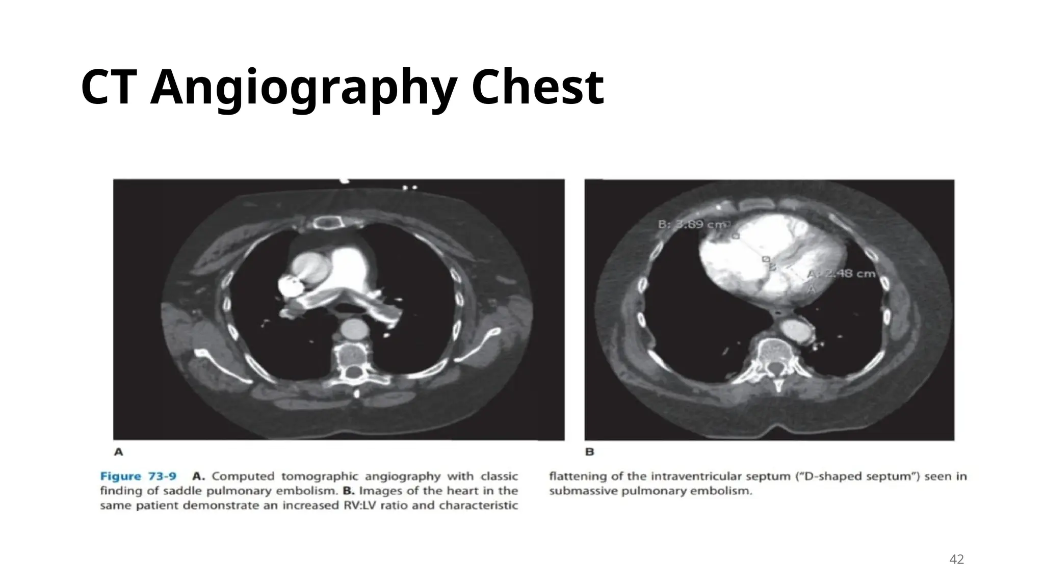 PULMONARY EMBOLISM clinical features and diagnosis | PPT