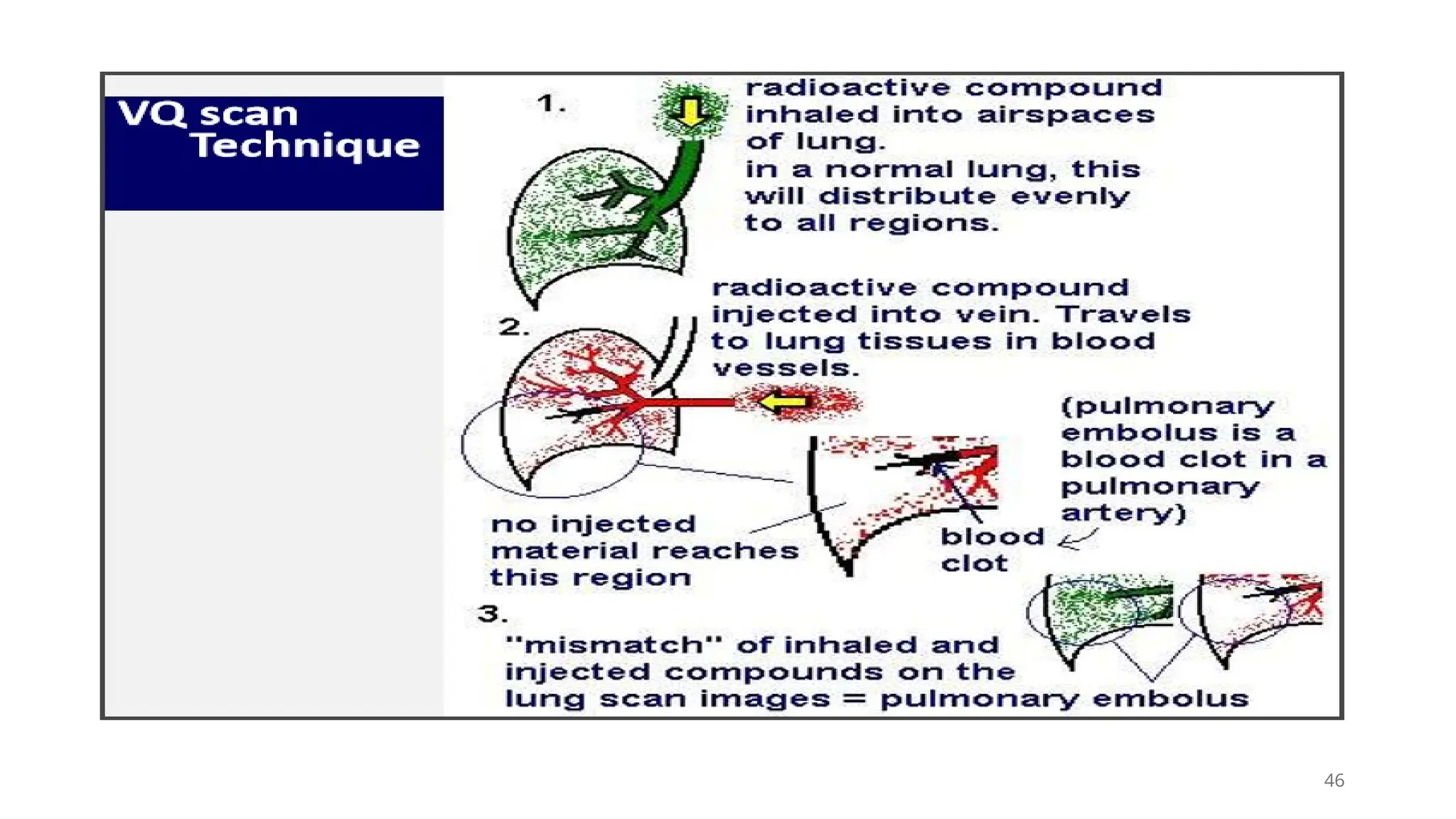 PULMONARY EMBOLISM clinical features and diagnosis | PPT