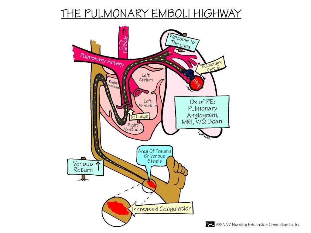 Pulmonary embolism