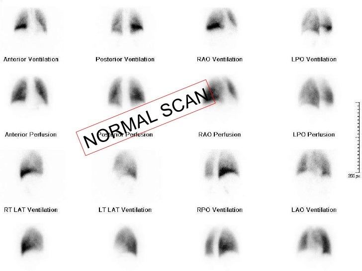 Pulmonary embolism and lung scans