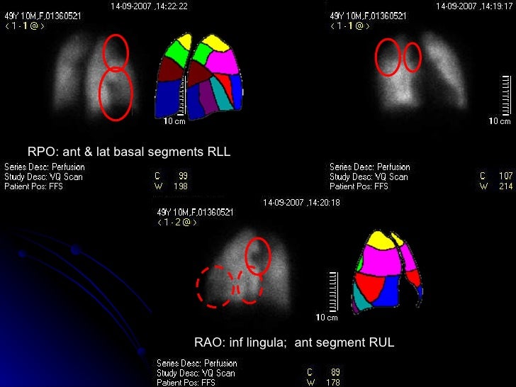 Pulmonary embolism and lung scans