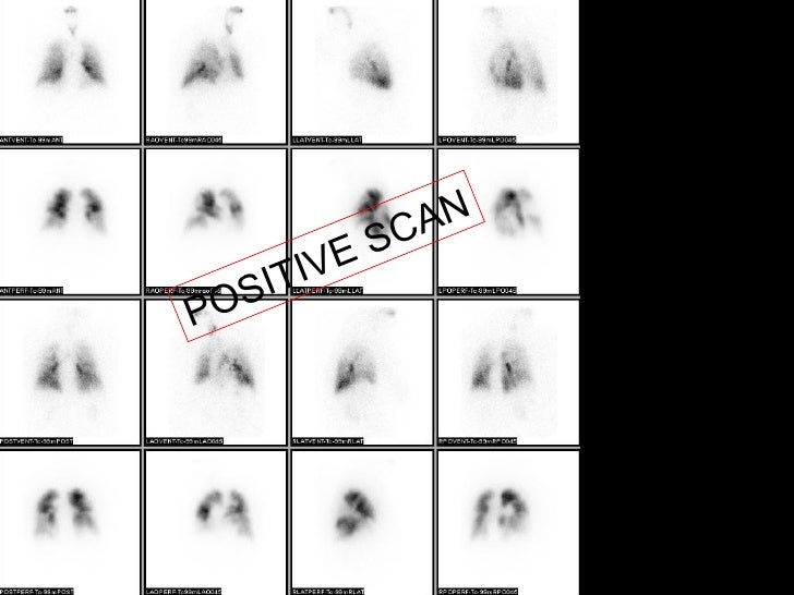 Pulmonary embolism and lung scans