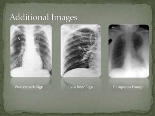 Pulmonary Embolism Power Point | PPT