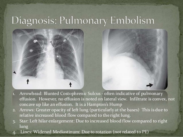 Pulmonary Embolism Power Point