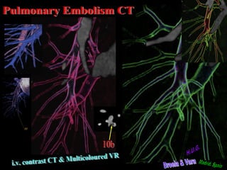 Pulmonary Embolism CT | PPT
