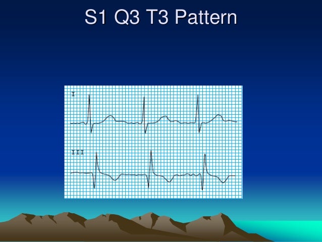 Pulmonary embolism,overview