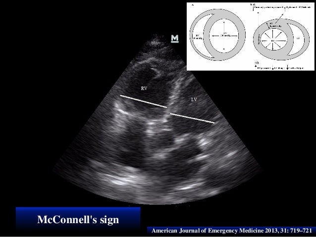 Pulmonary embolism