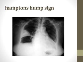 Pulmonary embolism | PPTX